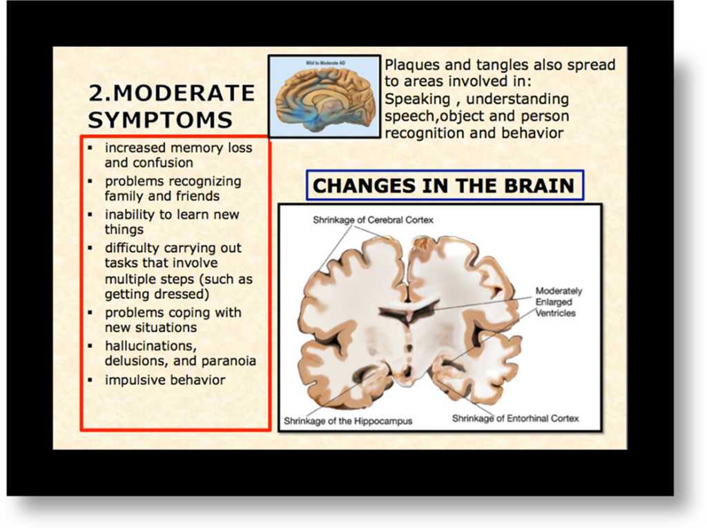 Stages of Alzheimer’s Disease – Dementia Awareness Research Group of ...